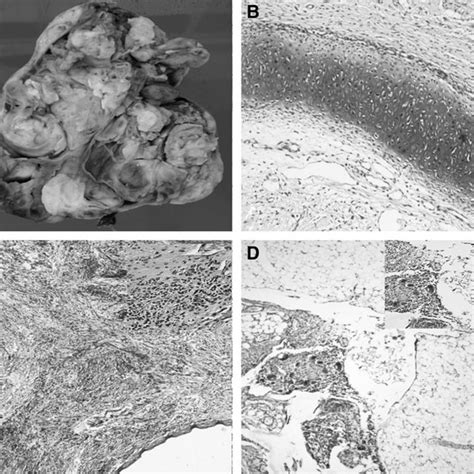 A Gross Photograph Showing Predominantly Solid Adnexal Mass With Download Scientific Diagram