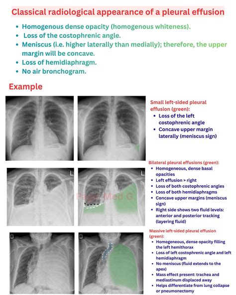 The Heart 📌 Classical And Updated Radiological Appearance Of Pleural