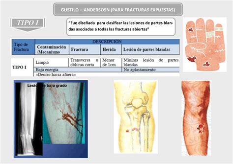 ClasificaciÓn De Gustilo Y Anderson Docsity