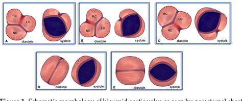 Figure 1 From Aortic Dilatation In Pediatric Patients With Bicuspid