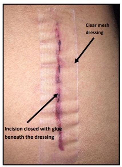 Prineo Instructions Hawaii Joint