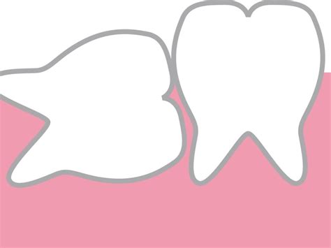 親知らずはいつ生える？前兆や抜歯の判断・対処法を解説 ｜ おばた歯科・矯正歯科｜名古屋市守山区の歯医者