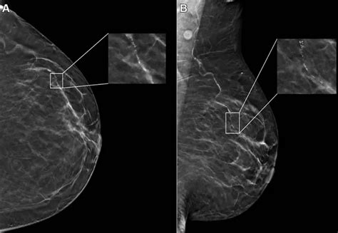 Example Mammogram Assigned A F [image] Eurekalert Science News Releases