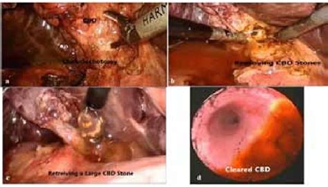 A Performance Of Choledochotomy Using Harmonic Scalpel B C