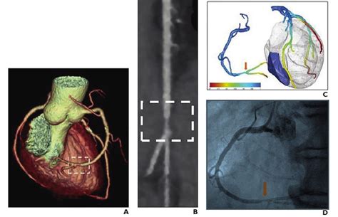 dl based rapid ffr ct algorithm facilitates clinical adoption