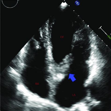 Long Axis Tee View Showing Thickened Aortomitral Continuity Arrow A Download Scientific