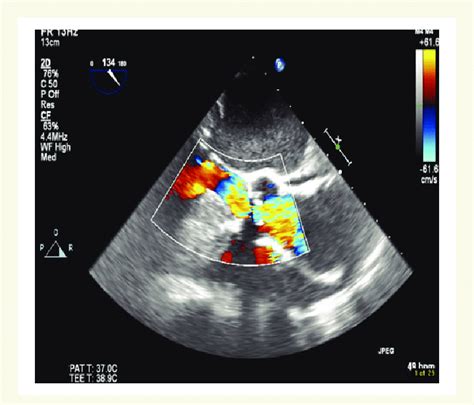 Unsuitable Anatomy Severe Basal Interventricular Septal Hypertrophy