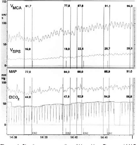 Structure Of Sphenoparietal Sinus Semantic Scholar