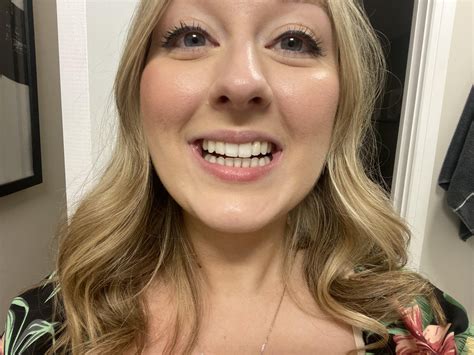 Attachments Off 🎉 Rinvisalign