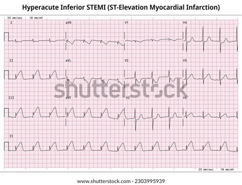Inferior Stemi