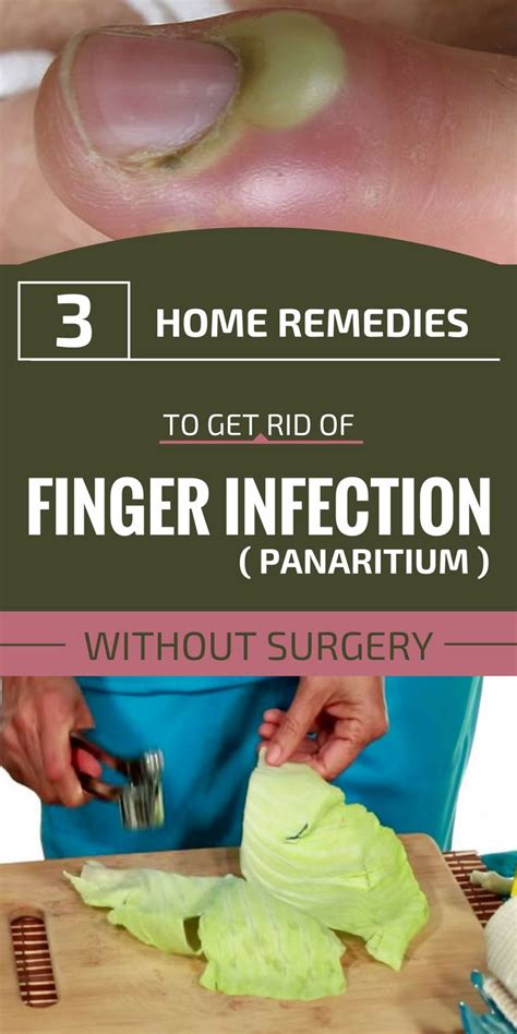 3 Home Remedies To Get Rid Of Finger Infection Panaritium Without