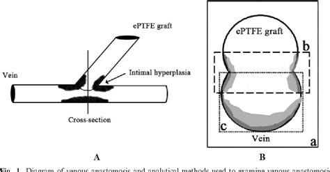 Polytetrafluoroethylene Graft