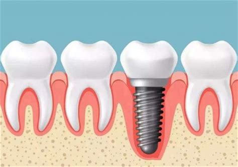 不同牙位牙齿种植的黄金时间一样吗 知乎