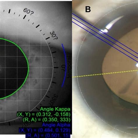 A The Itrace Aberrometry Examination Showing The Center Of The Optic Download Scientific