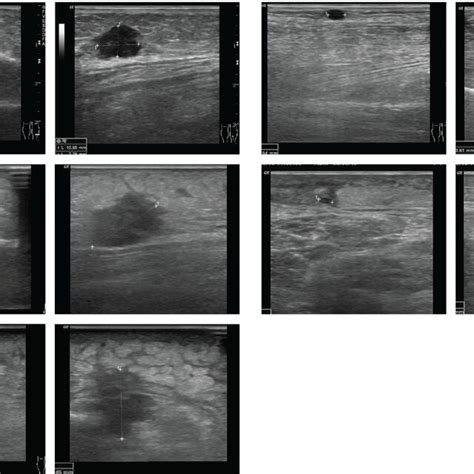 Course Of Subcutaneous Melanoma Metastases Under Combination Of Mek