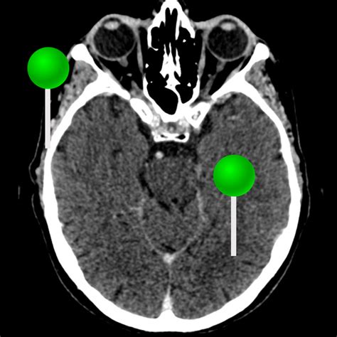 Midbrain Ct