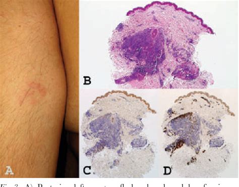 Figure 2 From Primary Cutaneous Marginal Zone Bcell Lymphoma With Anetoderma Spontaneous Figure 2 From Primary Cutaneous Marginal Zone Bcell Lymphoma With Anetoderma Spontaneous