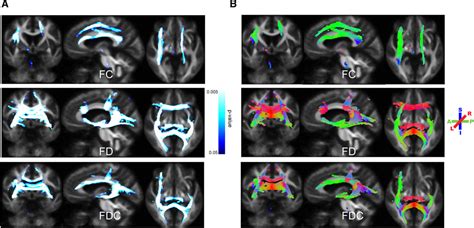Pervasive White Matter Fiber Degeneration In Ischemic Stroke Stroke