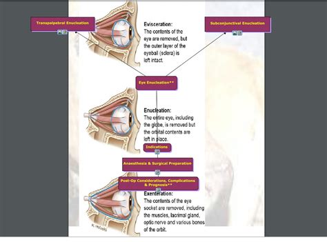 Eye Enucleation