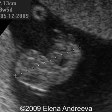 📃 Ectopia Cordis 9 Weeks