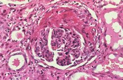 USMLE Pathology Slides Focal Segmental Glomerulosclerosis Nephrotic