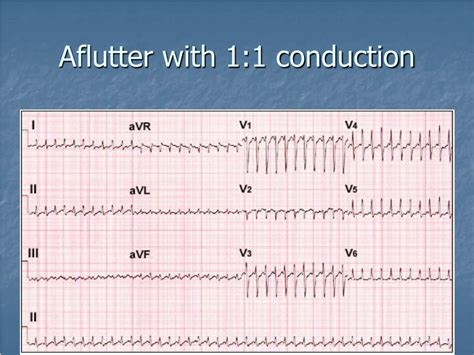 Ppt Interpretation Of Electrocardiograms Powerpoint Presentation Free Download Id 9427334