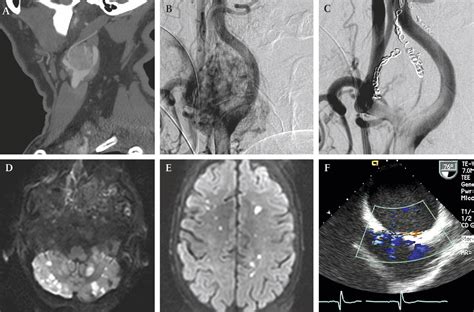 Paradoxical Embolus To The Brain From Embolization Of A Carotid Body Tumor Journal Of
