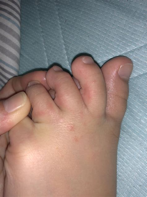 汗疱状湿疹が悪化？ Alonのブログ