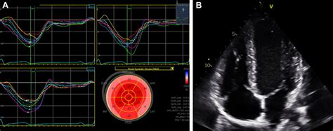Echocardiographic Myocardial Strain Download Scientific Diagram