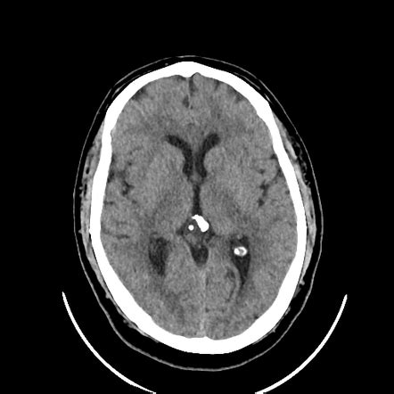 Pineal Gland Cyst Radiology Kyste Glande Pineale Byzok