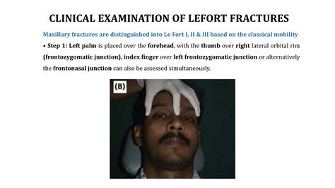 Lefort Fracturespptx