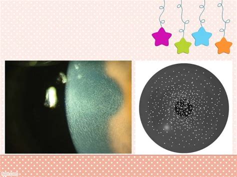 Diffuse Lamellar Keratitis Dlk Ppt Eye And Vision Conditions