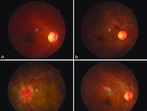 Fundus Image Showing A Grade 2 Hypertensive Retinopathy B Grade 3