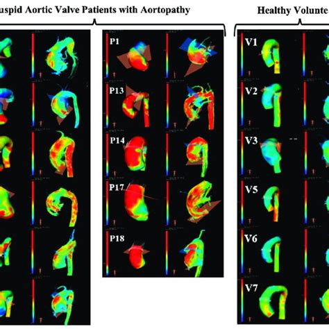 Wave Intensity Waveforms Of A Bav Patient Left And A Healthy