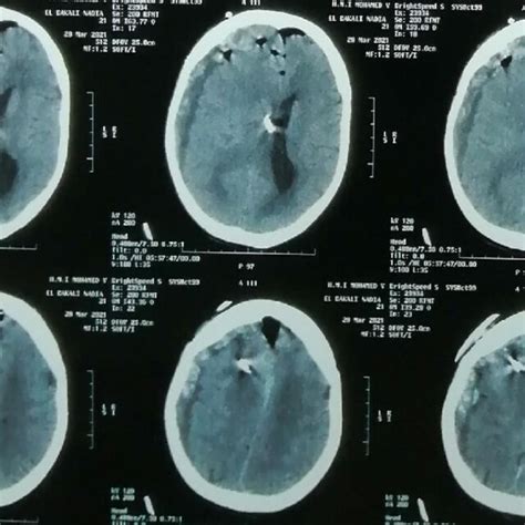 Appearance Of Acute Subdural Right Hemispheric Hematoma 7h After The