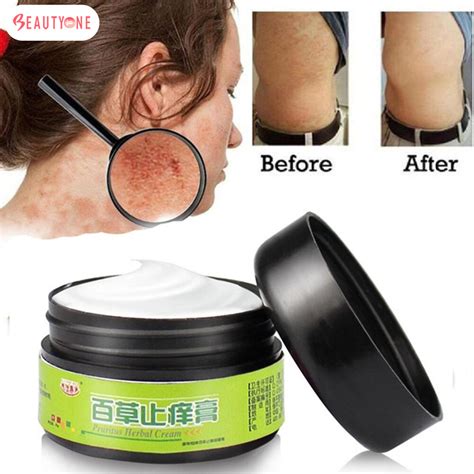 Ringworm Treatment Mupirocin At Lucinda Mccathie Blog