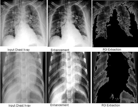 Illustrations Of ROI Extraction Of Raw X Ray Images Download Scientific Diagram