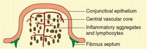 Follicular Vs Papillary Conjunctivitis