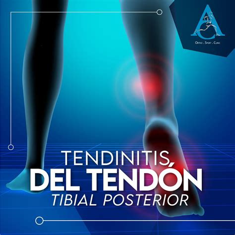 Los Síntomas De La Tendinitis Del Dr Andrés Castillo A