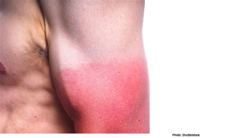 Top 6 Most Embarrassing Yet Common Tan Lines