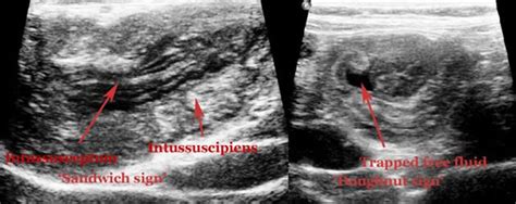 Intussusception Causes Symptoms Diagnosis Treatment