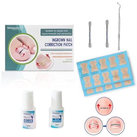 Ingrown Toenail Corrector Toenail Splint Dual Nitinol Ingrown Nail