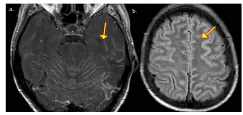 Fungal Meningitis Mri