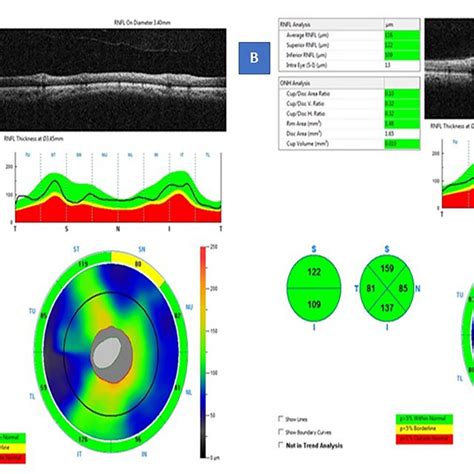 Example Of Rnflt Maps In A Postmenopausal And A Premenopausal