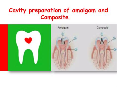 Amalgam Andcomposite Pptx