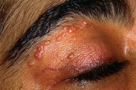 17 Common Causes Of Raised Skin Bumps With Pictures