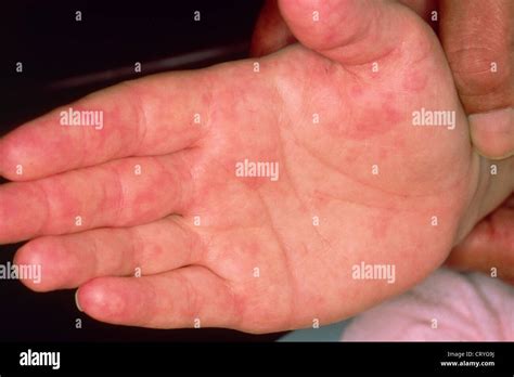 DRUG CAUSED RASH Stock Photo Alamy