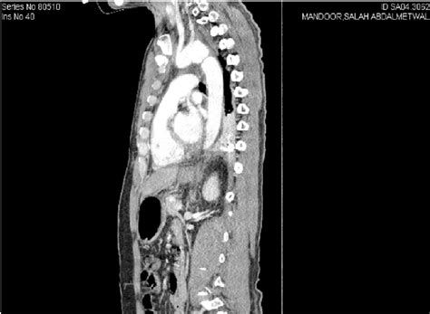 The Descending Thoracic Aorta Appears Totally Transected Download