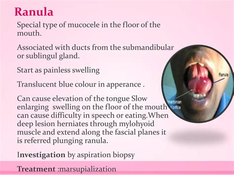 Salivary Gland Diseases Pptx Ear Nose And Throat Conditions
