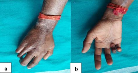 A And B Linear Morphea Affecting The Right Side Trunk And Upper Limb